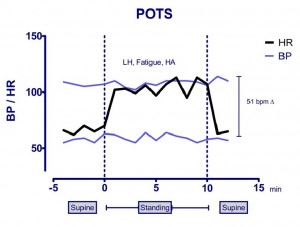 Postural Tachycardia Syndrome (POTS) | | Child Heart Specialist
