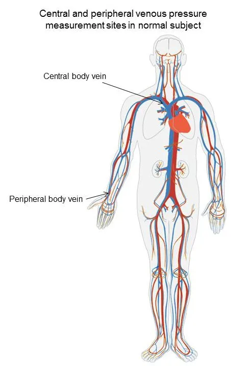 Measuring Central Venous Pressure