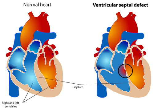 Ventricular Septal Defect Causes Types Symptoms 45 Off